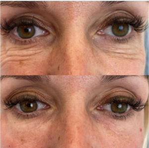 Juvelook & Lesina : Advanced Hybrid Collagen Stimulator